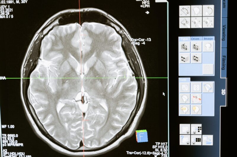 Sports-Related Concussion: What Happens in the Brain? - In Defense of ...